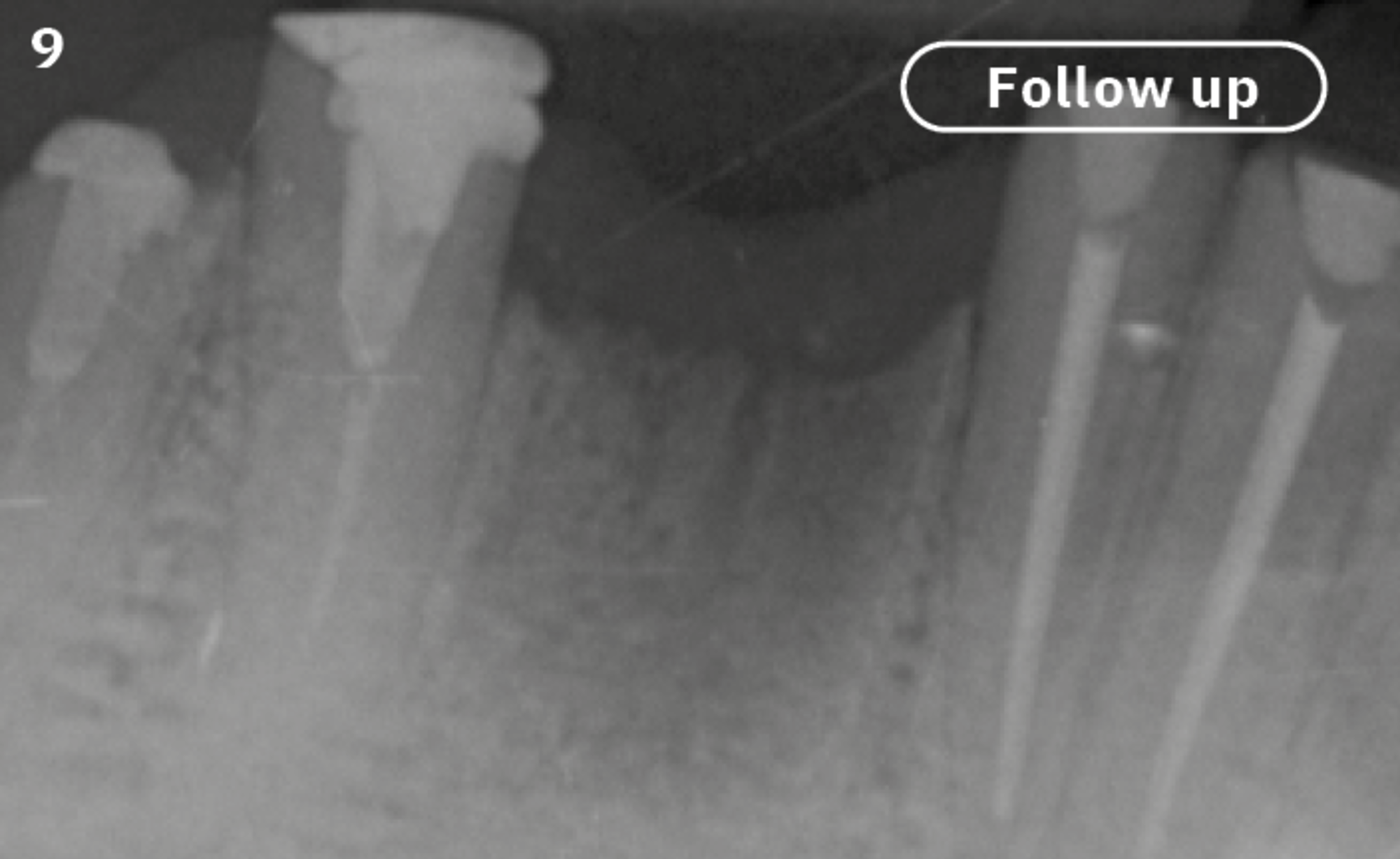 Regeneration Expert: Regenerative treatment of a site after osteonecrosis of the jaw