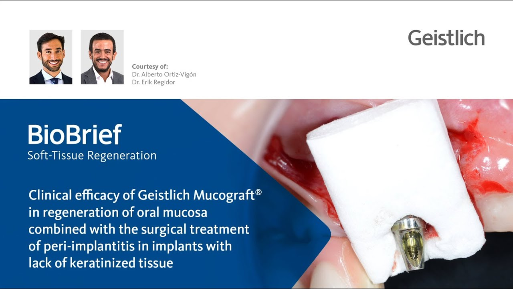 Regeneration Expert: Efficacy of Geistlich Mucograft ® for lack of ...