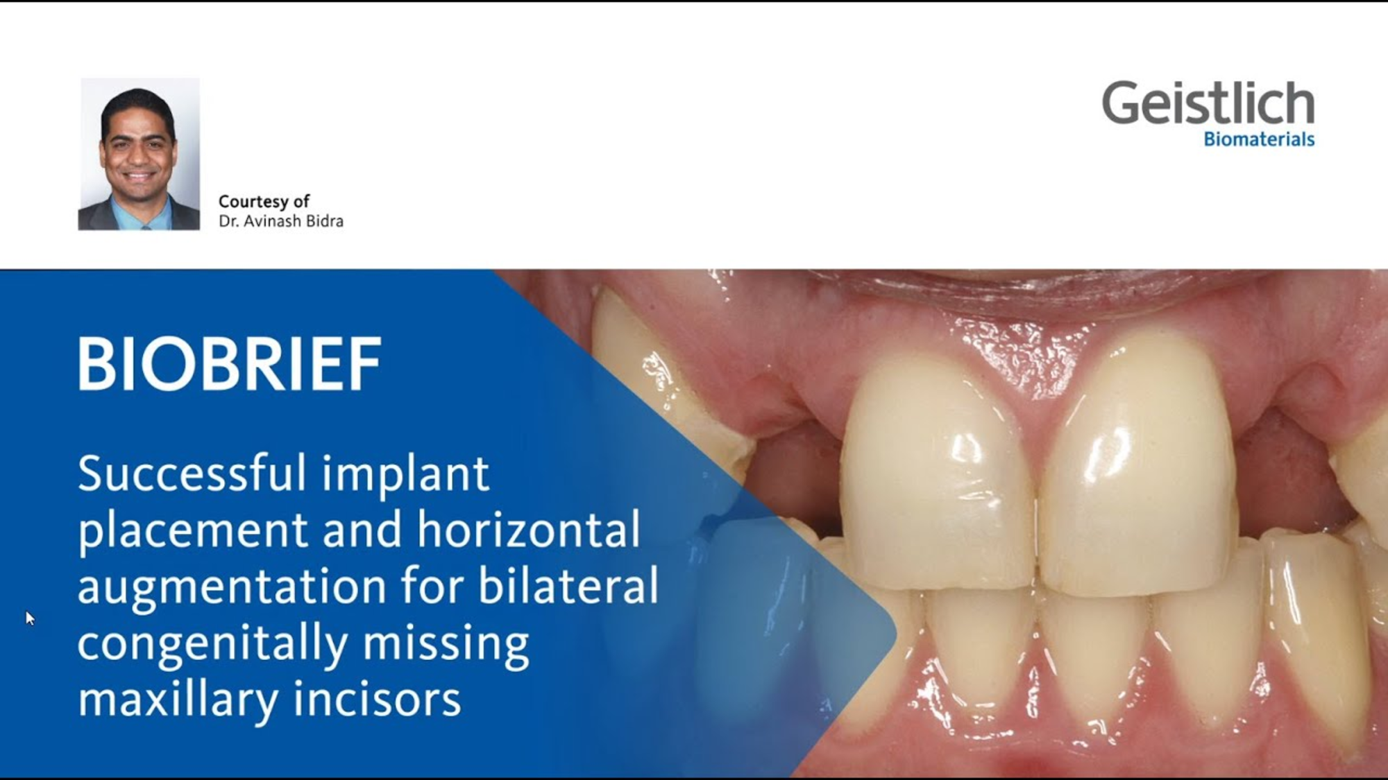 Regeneration Expert: Successful implant placement and horizontal ...