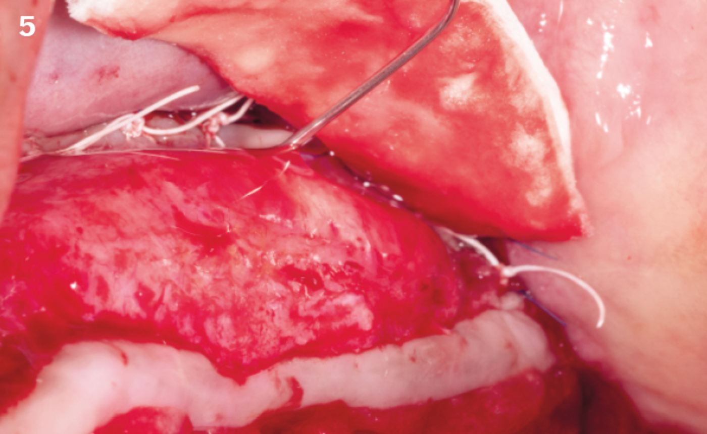 Regeneration Expert: Modified Strip Technique after bone augmentation ...